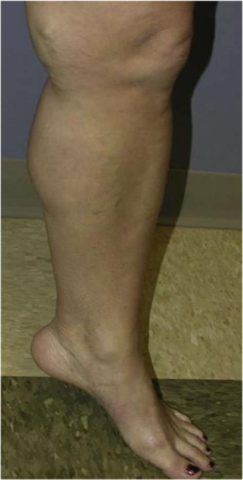 Superficial Venous Disease—an Updated Review Annals Of Vascular Surgery