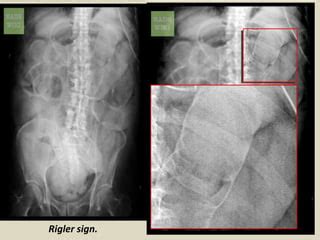 Presentation1 Interpretation Of X Ray Of The Abdomen Pptx