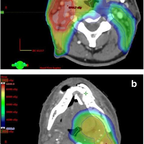 Normal Tissue Dose Constraints Used In RTOG For Partial Breast Download Table