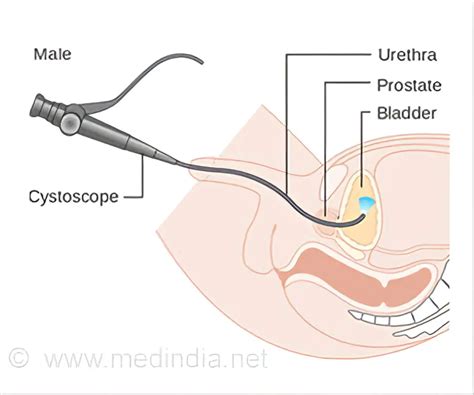 Cystoscopy Indications Price Course Of Examination What Are The