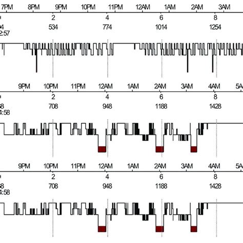 sleep histogram a sleep histogram in a patient with lgi1 antibody