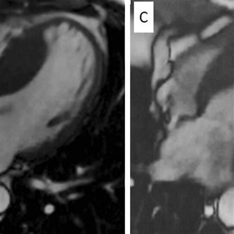 Left Ventricular Hypertrophy Patterns In Hypertrophic Cardiomyopathy Download Scientific