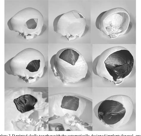 Figure 1 From Deep Learning Based Framework For Automatic Cranial Defect Reconstruction And