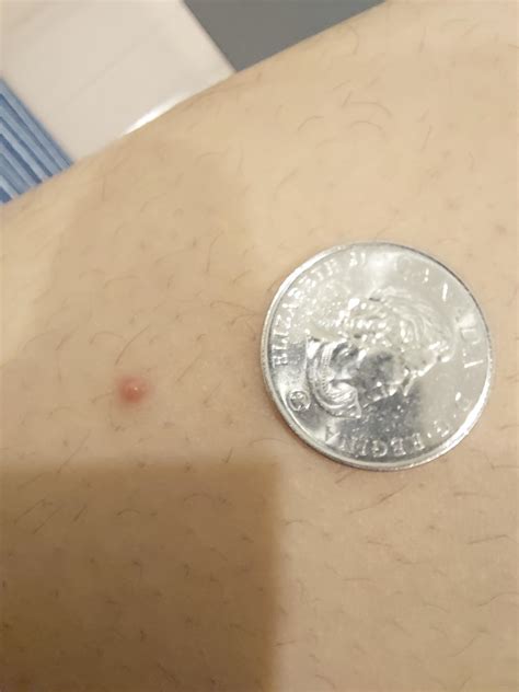 Singular Bite With Canadian Quarter For Scale R Bugbites