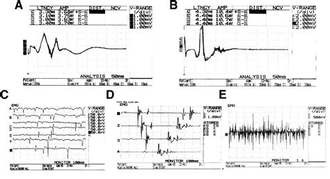Structure Of Dorsal Scapular Nerve Semantic Scholar