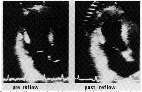 Anterior Myocardial Infarction Semantic Scholar
