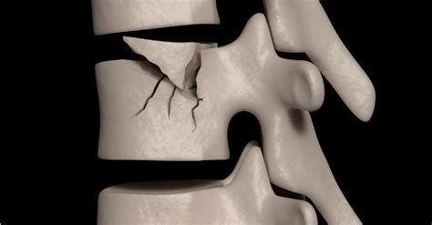 Vertebral Compression Fracture Management And Prevention Dr James Sheehan