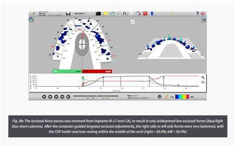 Utilizing Digital Occlusal Indicators To Increase Occlusal Accuracy And