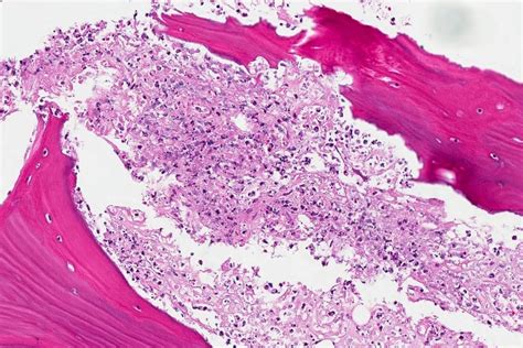 31 Facts About Abscess