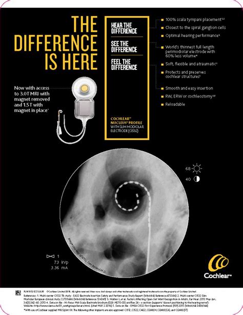The Perimodiolar Advantage With The Cochlear Ci532 Slim Modiolar