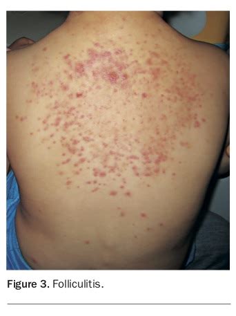An Erythematous Pustular Rash On The Torso And Limbs Medicine Today