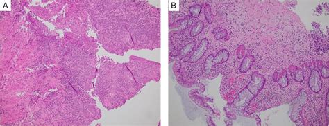 A Initial Colonic Biopsy Demonstrating Active Chronic Colitis With