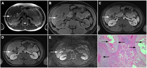 Current Oncology Free Full Text Imaging Spectrum Of Intrahepatic Mass Forming