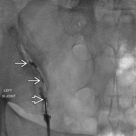 Sacroiliac Joint Injection Clinical Tree