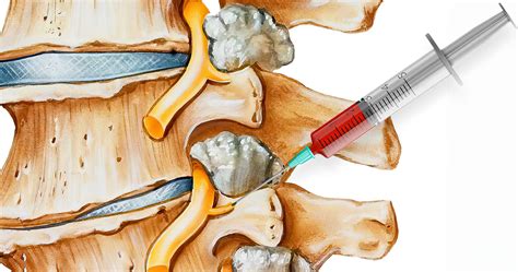 Medial Branch Block Trimed Spine And Joint