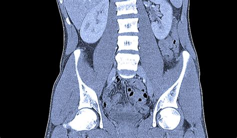Is CT Scan Contrast Dangerous Here S What You Need To Know CT Scan Lucknow