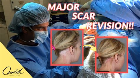Revision Facelift With Scar Excision Before And After Youtube