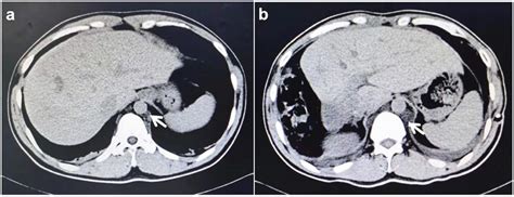 Figure 1 From Endothoracic Lymphatic Plexus‑hemiazygos Vein Anastomosis For Chylothorax