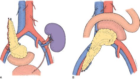Whole Organ Pancreas And Pancreatic Islet Transplantation Clinical Tree