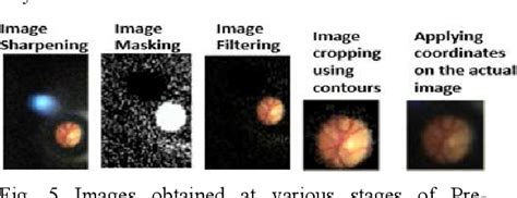 Figure 5 From Classification Of Fundus Images Captured Using D Eye Smartphone Retinal Imaging