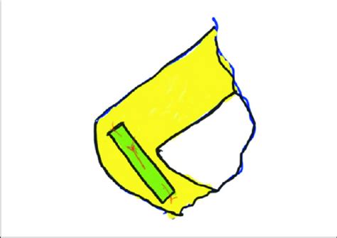 Pcl Is Used As A Batten Graft For Weak Or Deviated Caudal Strut The