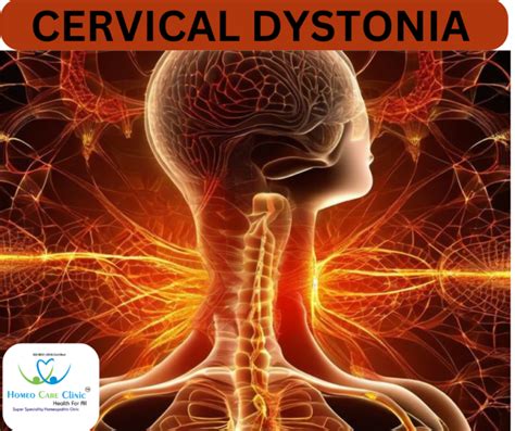 Spasmodic Torticollis Cervical Dystonia Causes Symptoms And Treatment