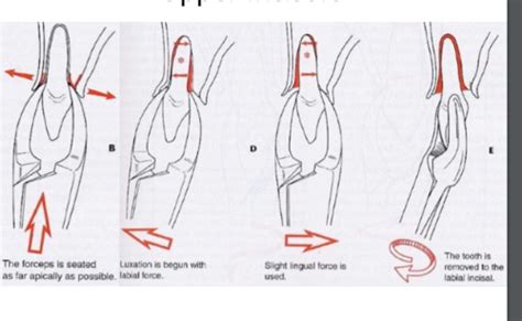 Overview Of Simple Extraction Techniques In Dentistry Flashcards Quizlet