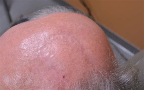 Before And After Photos Mohs Surgery Scalp 3 Nyc