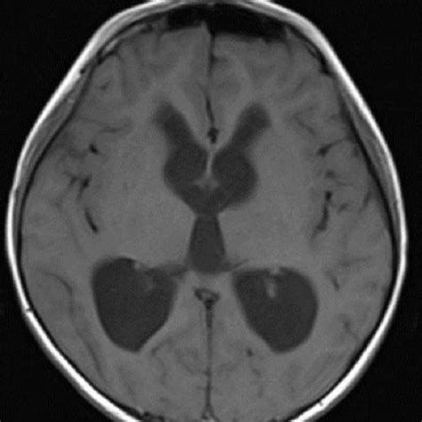 Mri Brain Tumor Dataset Binary Classification Kaggle