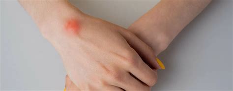 Kyste Sébacé Que Faire En Cas De Boule Dure Sous La Peau