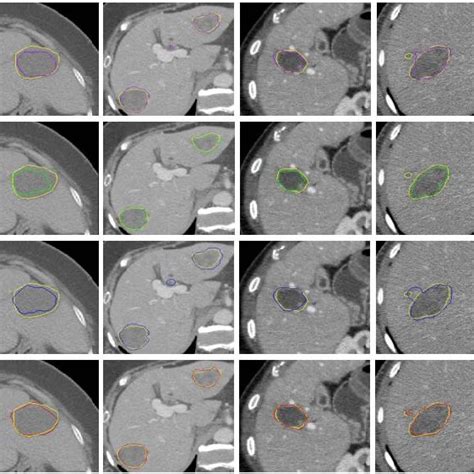 PDF Automatic Segmentation Of Liver Tumor In CT Images With Deep Convolutional Neural Networks
