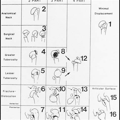 The 16 Categories Of The Neer Classification A Fracture Is Considered Download Scientific The 16 Categories Of The Neer Classification A Fracture Is Considered Download Scientific