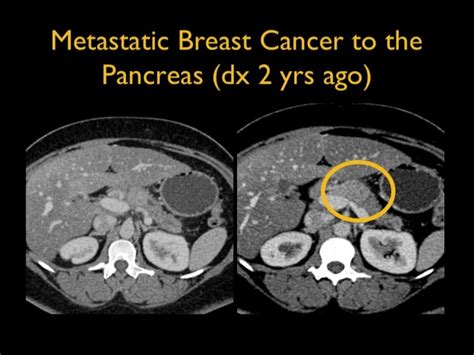 is pancreatic cancer seen on a ct scan