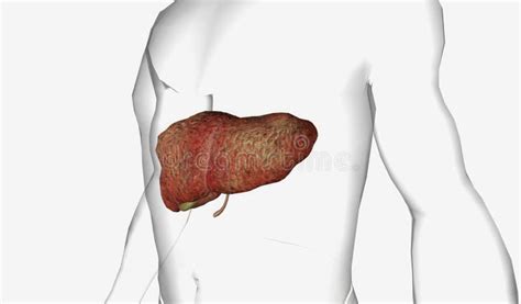 Primary Biliary Cholangitis Pbc Is An Autoimmune Disease Of Th Stock
