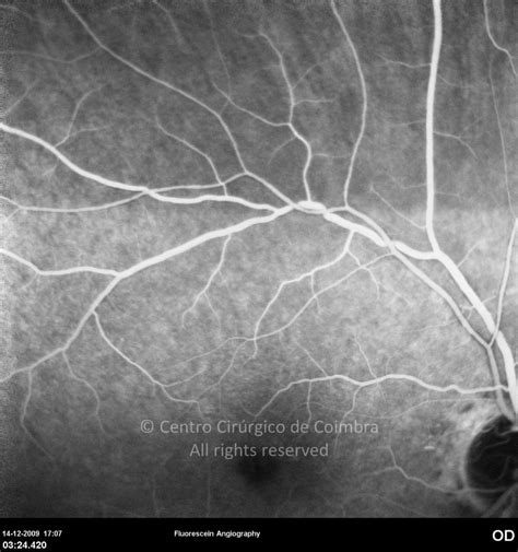 Hypertensive Retinopathy Atlas Rl Eye