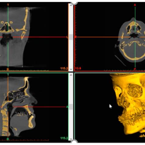 Anatomical Segmentation And Volumetric Data Extraction Mimics 3d Download Scientific Diagram