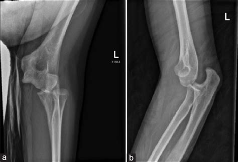 Elbow Dislocation In Sports A Narrative Review Journal Of