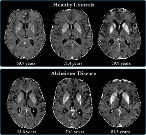 Brain Iron Accumulation Linked To Cognitive Decline In Alzheimers Neuroscience News
