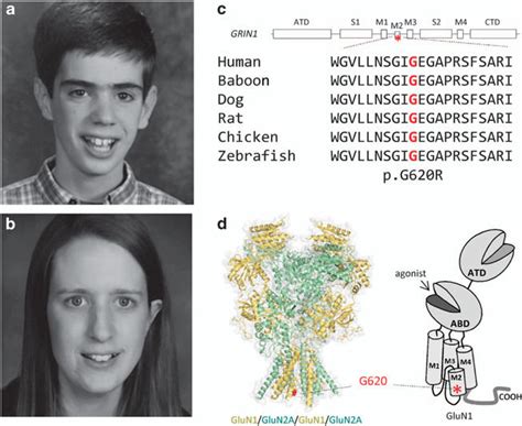 Identification Of A Grin1 Missense Mutation In Patients With