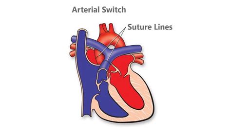 Arterial Switch Surgery