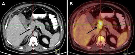 A B 55 Year Old Man With A Perihilar Infiltrative Cholangiocarcinoma