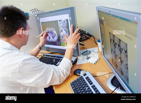 Imrt Intensity Modulated Radiation Therapy Abdomen Cancer 3d