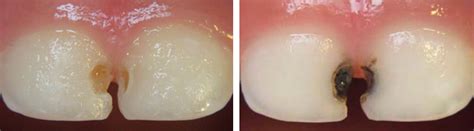 Massachusetts Medical Society Silver Diamine Fluoride Treatment For Cavities May Explain Black