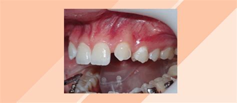Cuspid Substitutions By Dr Robert Tito Norris Orthotown