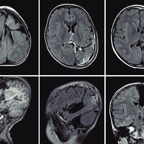 Disconnection Surgeries A Frontal Lobe Disconnection B Posterior Download Scientific