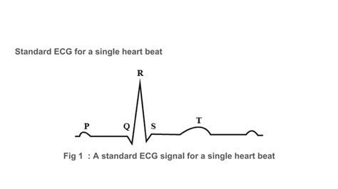 Myocardial Infarction Detection Using Ecgpptx