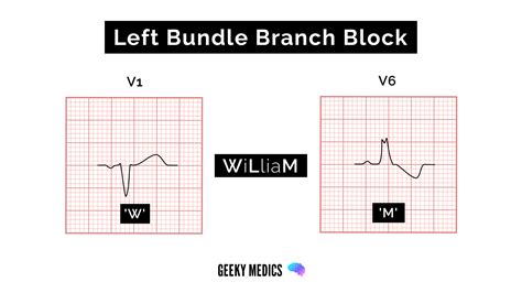Complete Heart Block Left Bundle Branch At Maria Baum Blog