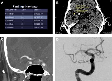 Figure 2 From Automated Intracranial Clot Detection A Promising Tool