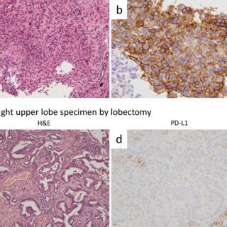 Figure2 Pathological Findings The Left Upper Lobe Specimen By Biopsy Download Scientific