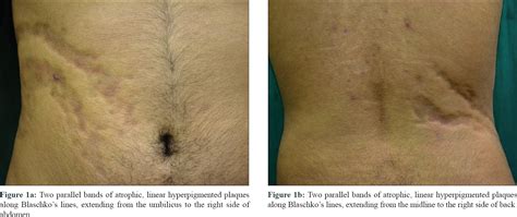 Linear Atrophoderma Of Moulin A Rare Entity Indian Journal Of Dermatology Venereology And